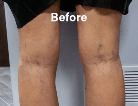Vein Center Maryland | Bethesda Vein Doctors